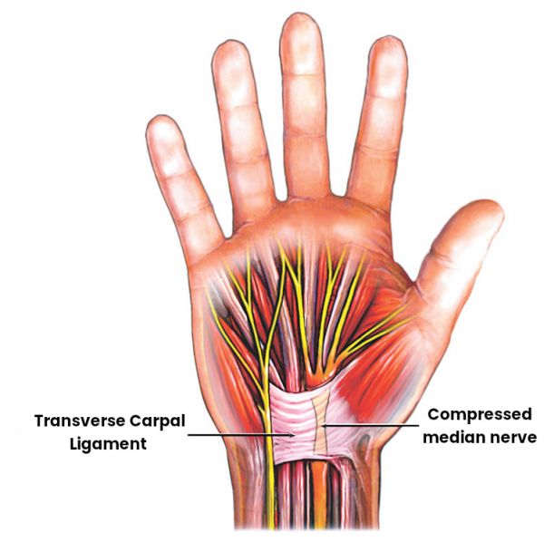 Carpal Tunnel Syndrome - The Complete Guide