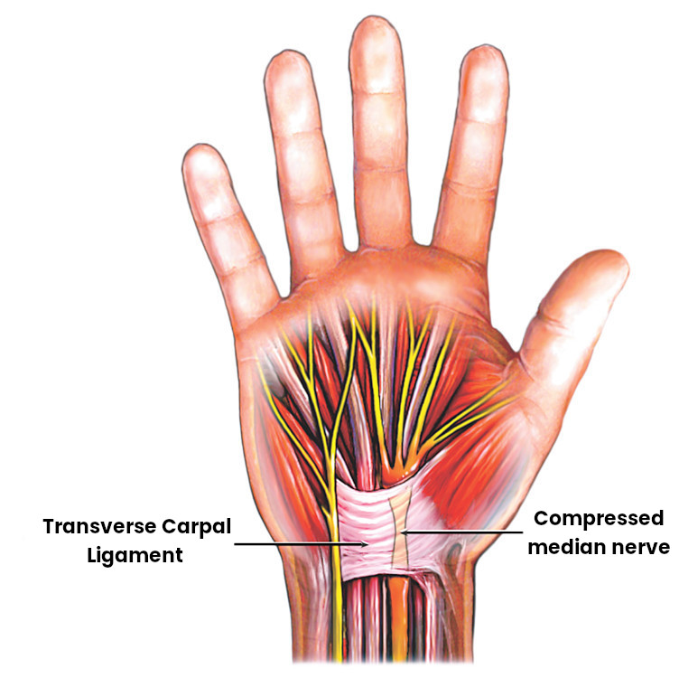 Carpal Tunnel Syndrome - The Complete Guide