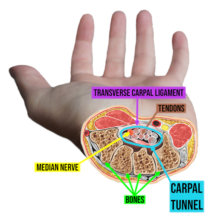 Carpal Tunnel Syndrome - The Complete Guide