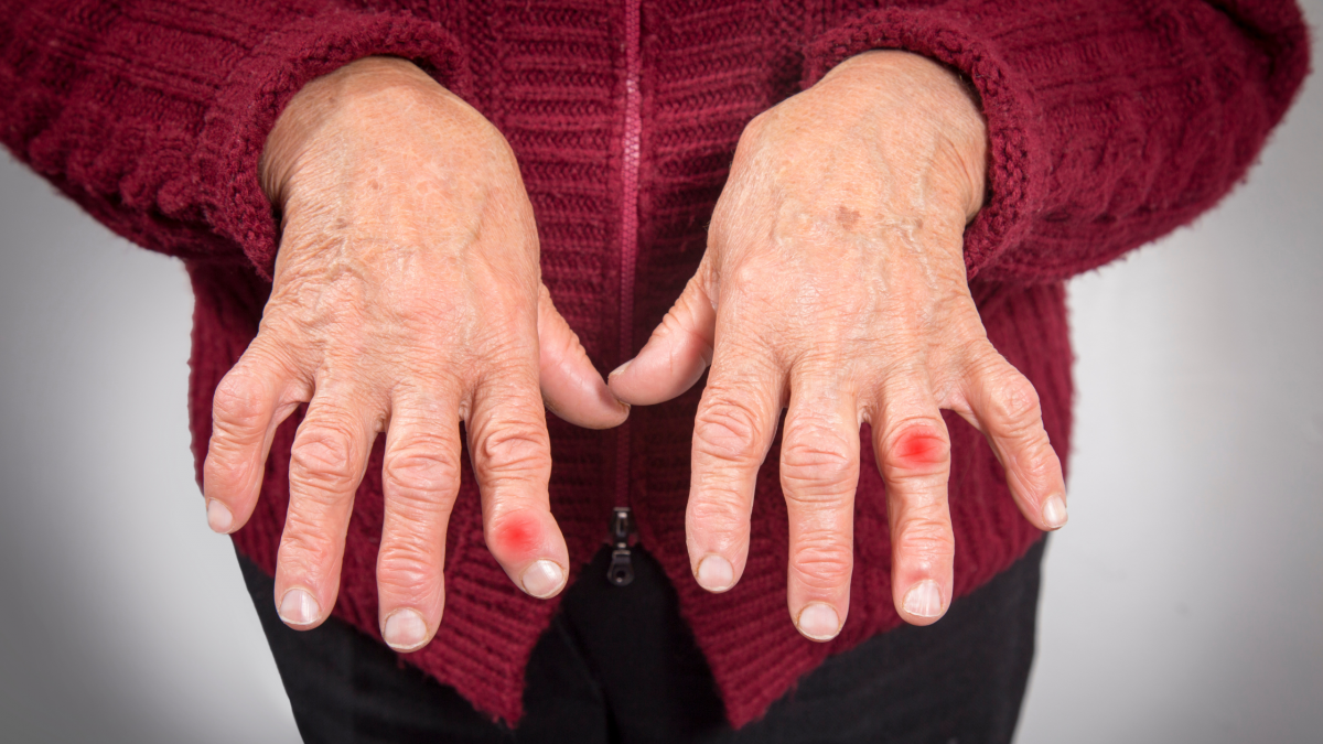 How Successful Is Hand Surgery for Arthritis? - The Nerve Surgery Centre