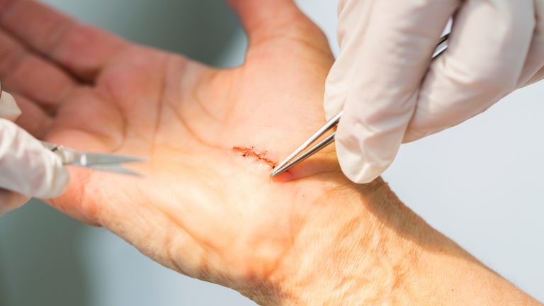 How To Break Up Scar Tissue After Carpal Tunnel Surgery - The Nerve ...