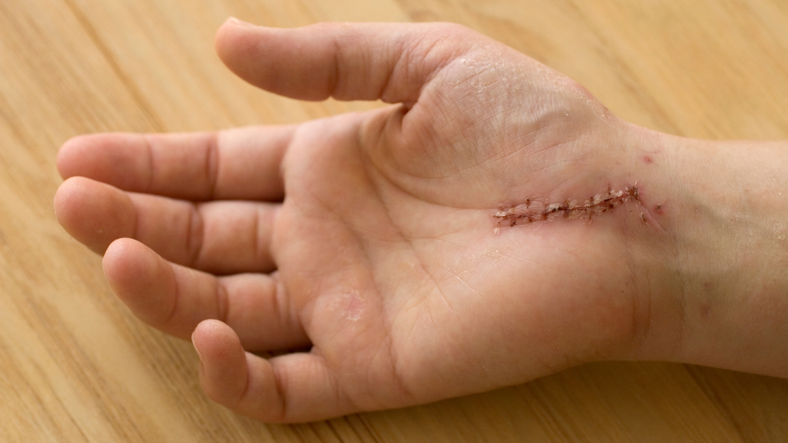 How To Break Up Scar Tissue After Carpal Tunnel Surgery - The Nerve ...